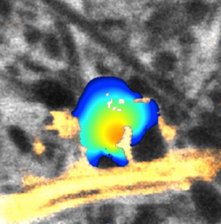 New collaborative project to computationally model brain diffusion ...