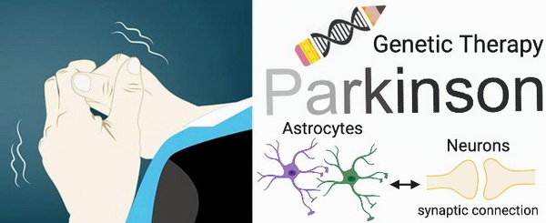 Treating Parkinson's disease by genetic therapy - Achucarro Basque ...